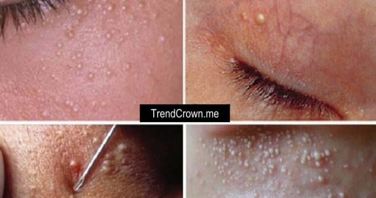 Get rid of annoying white skin cysts using these simple remedies!