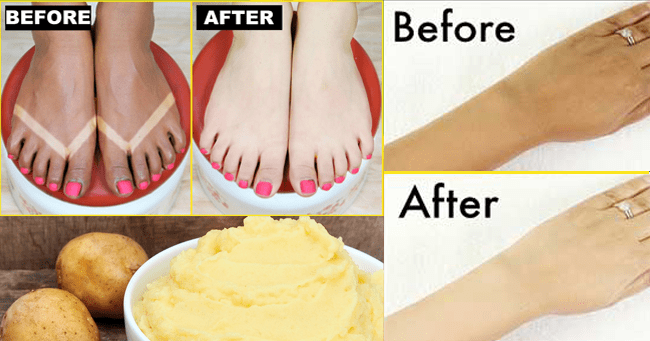 How to remove sun tan naturally at home