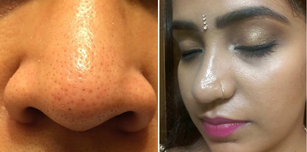 Get rid of the oily nose by using these effective remedies
